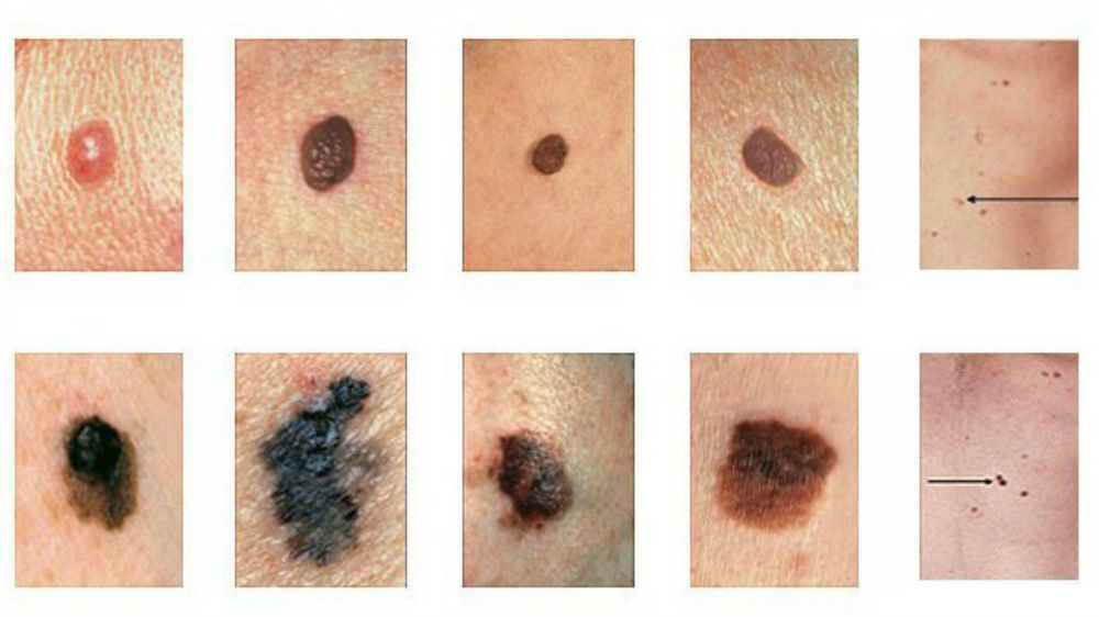 Record di melanomi in Italia: 6 accorgimenti per individuare NEI pericolosi